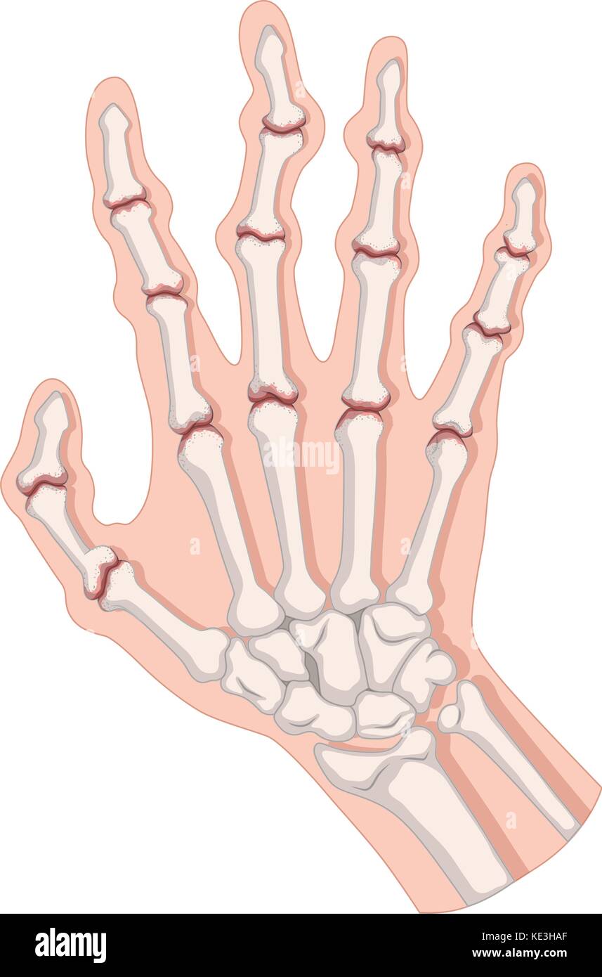 Rheumatoid arthritis in human hand illustration Stock Vector Image ...