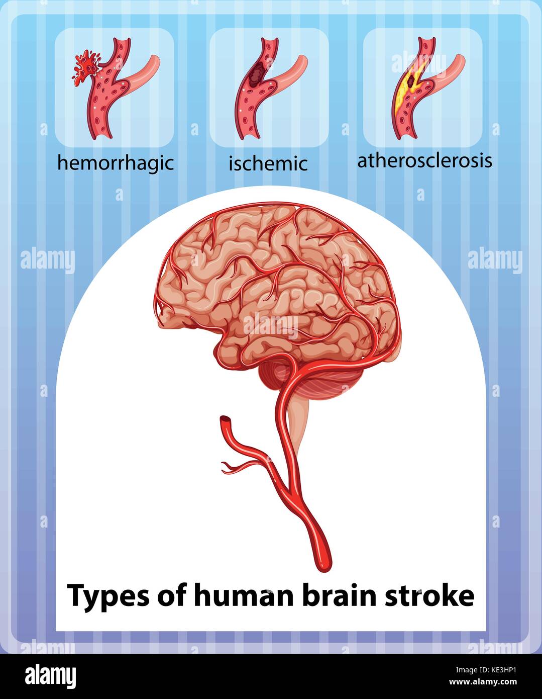Human Brain After Stroke