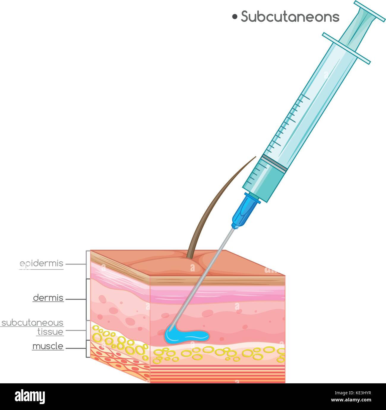 Diagram showing subcutaneons injection illustration Stock Vector Image ...