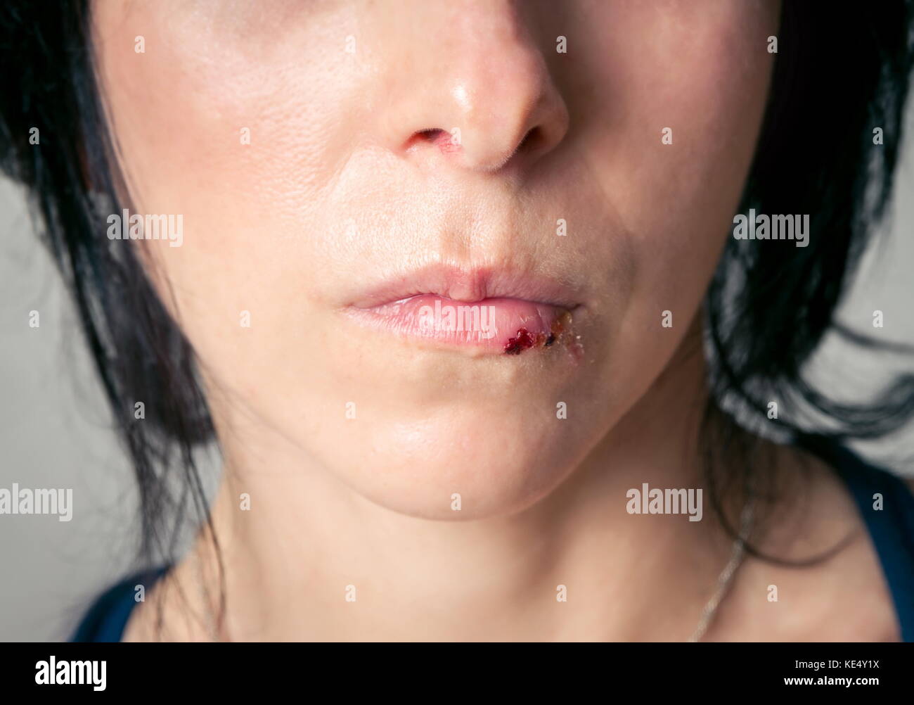 Woman face with injury. Home violence Stock Photo - Alamy