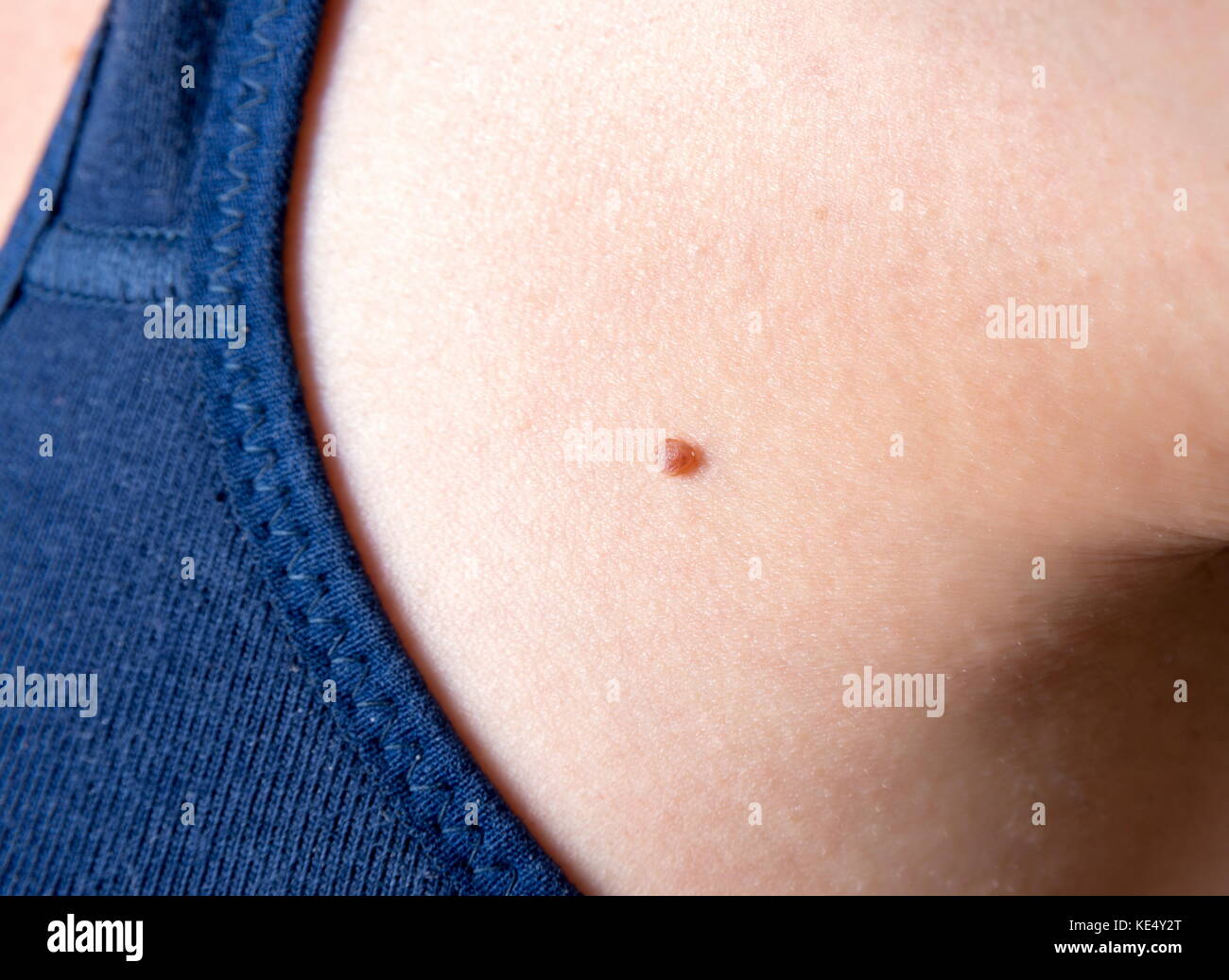 Closeup of the mole on female body Stock Photo - Alamy