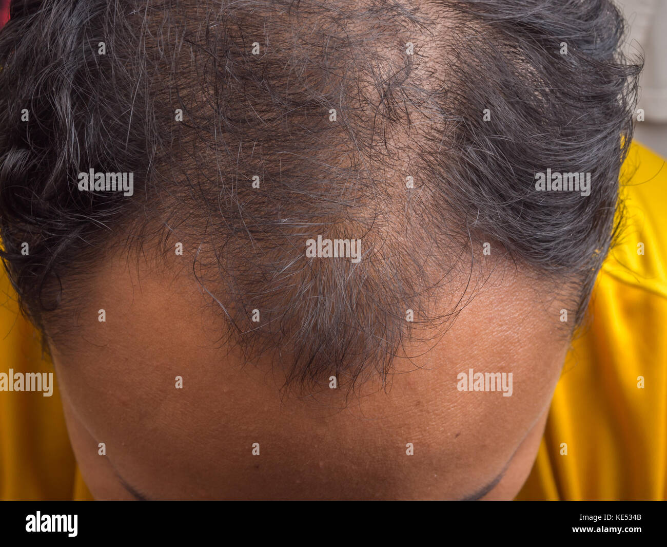 closeup of hairlose or bald head man Stock Photo - Alamy