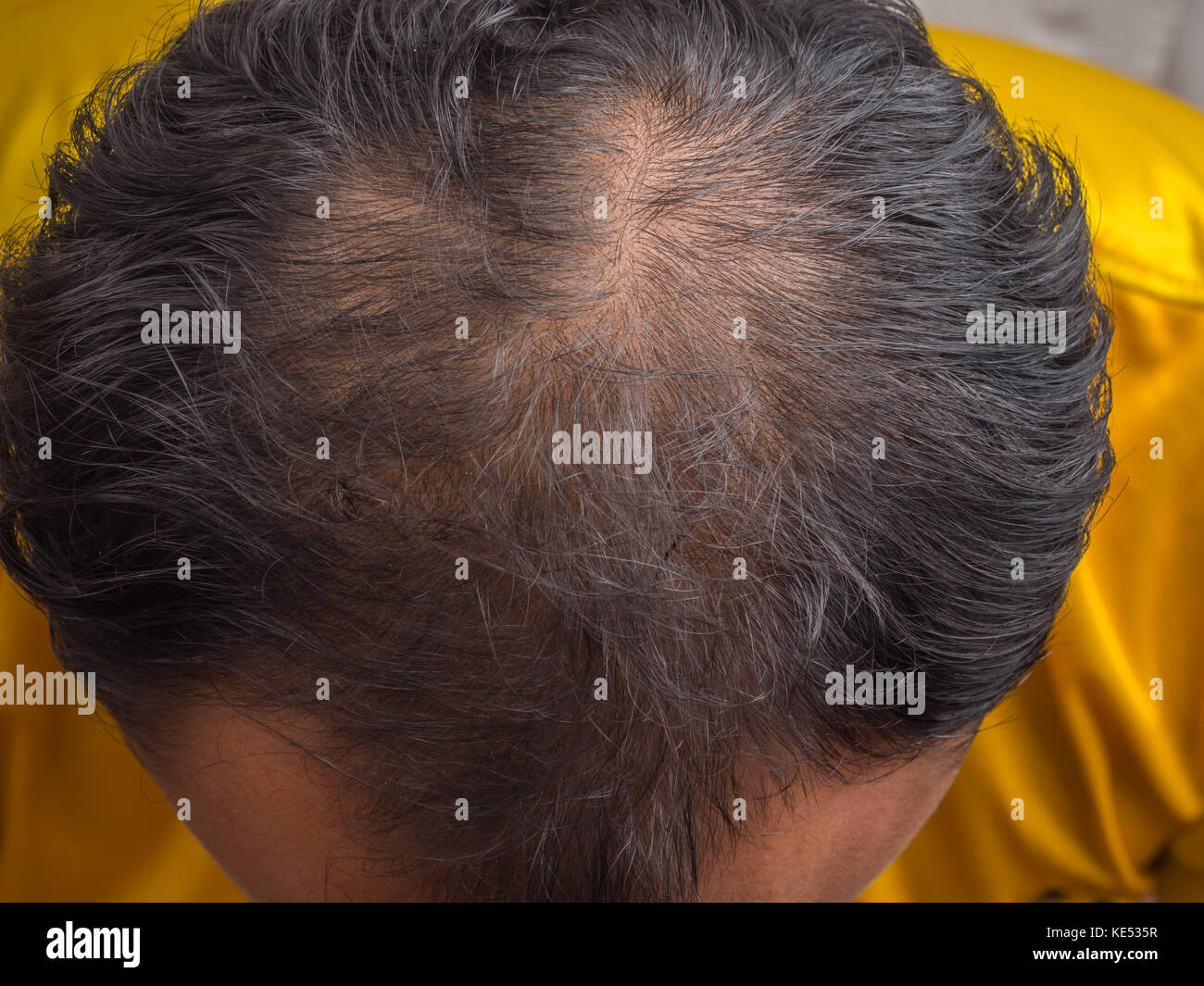 closeup of hairlose or bald head man Stock Photo - Alamy