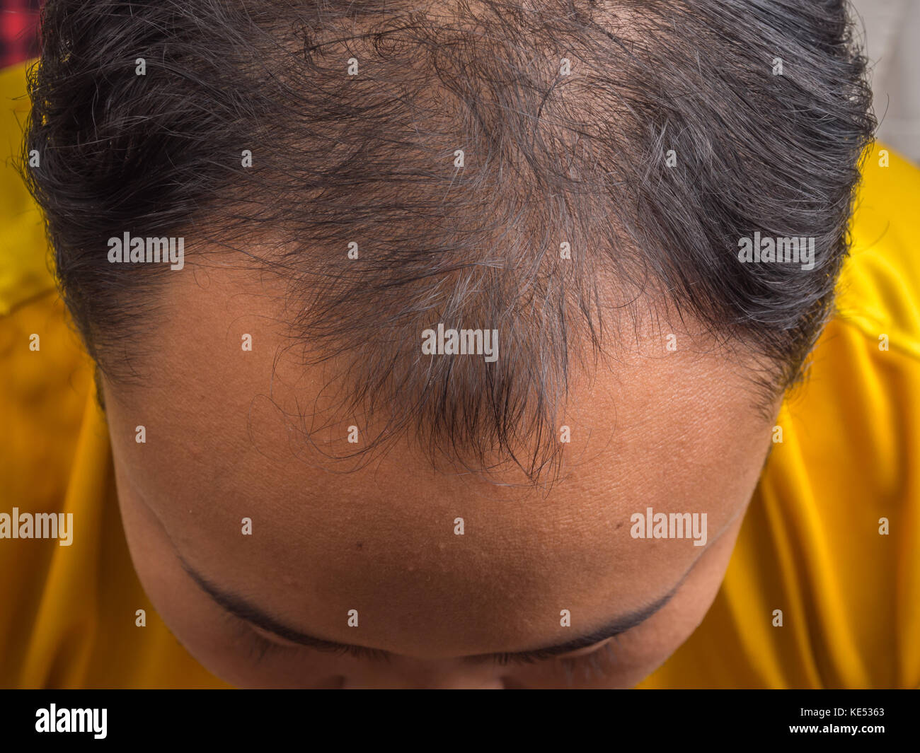 closeup of hairlose or bald head man Stock Photo - Alamy
