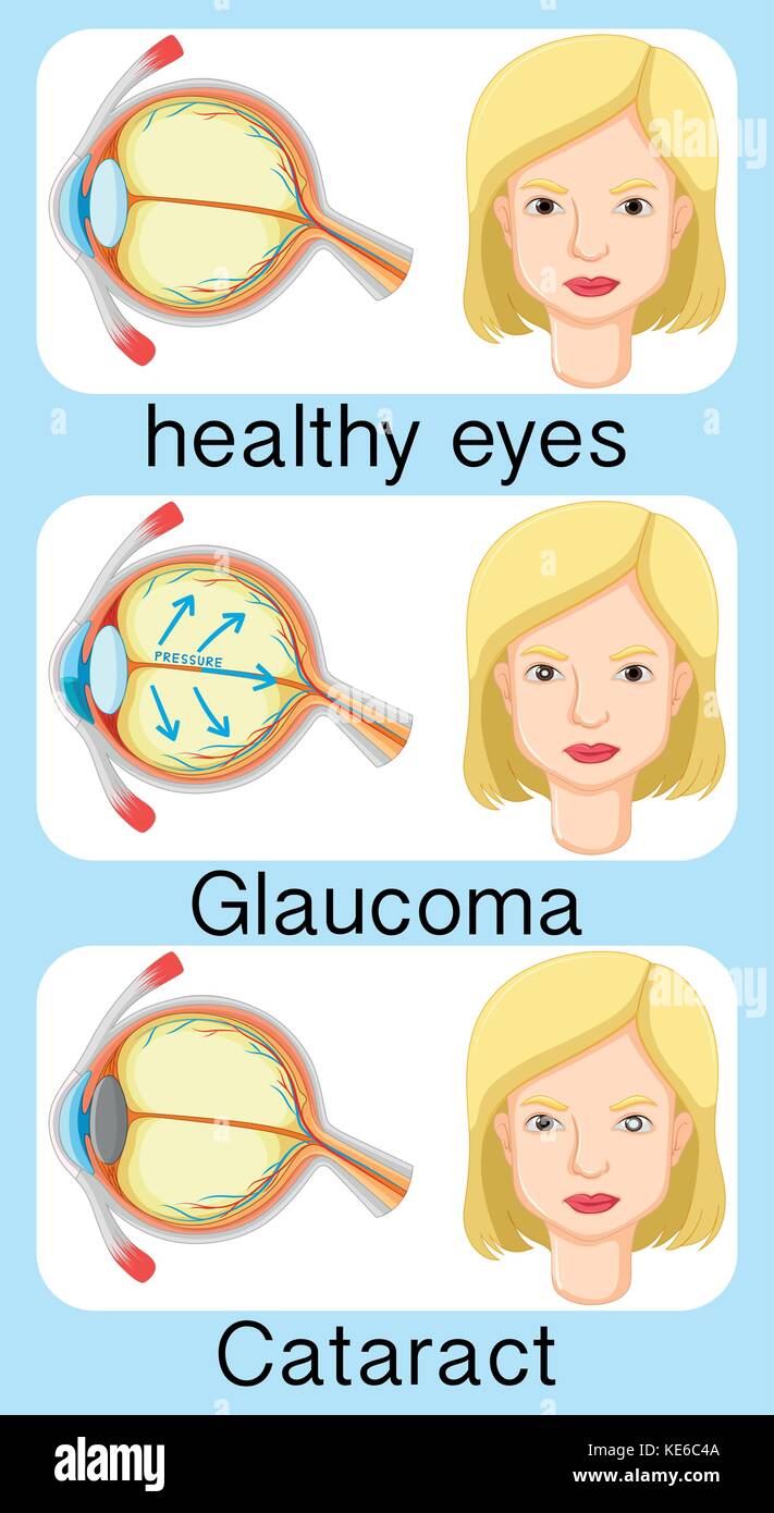 Woman with different eyes problems illustration Stock Vector Image ...