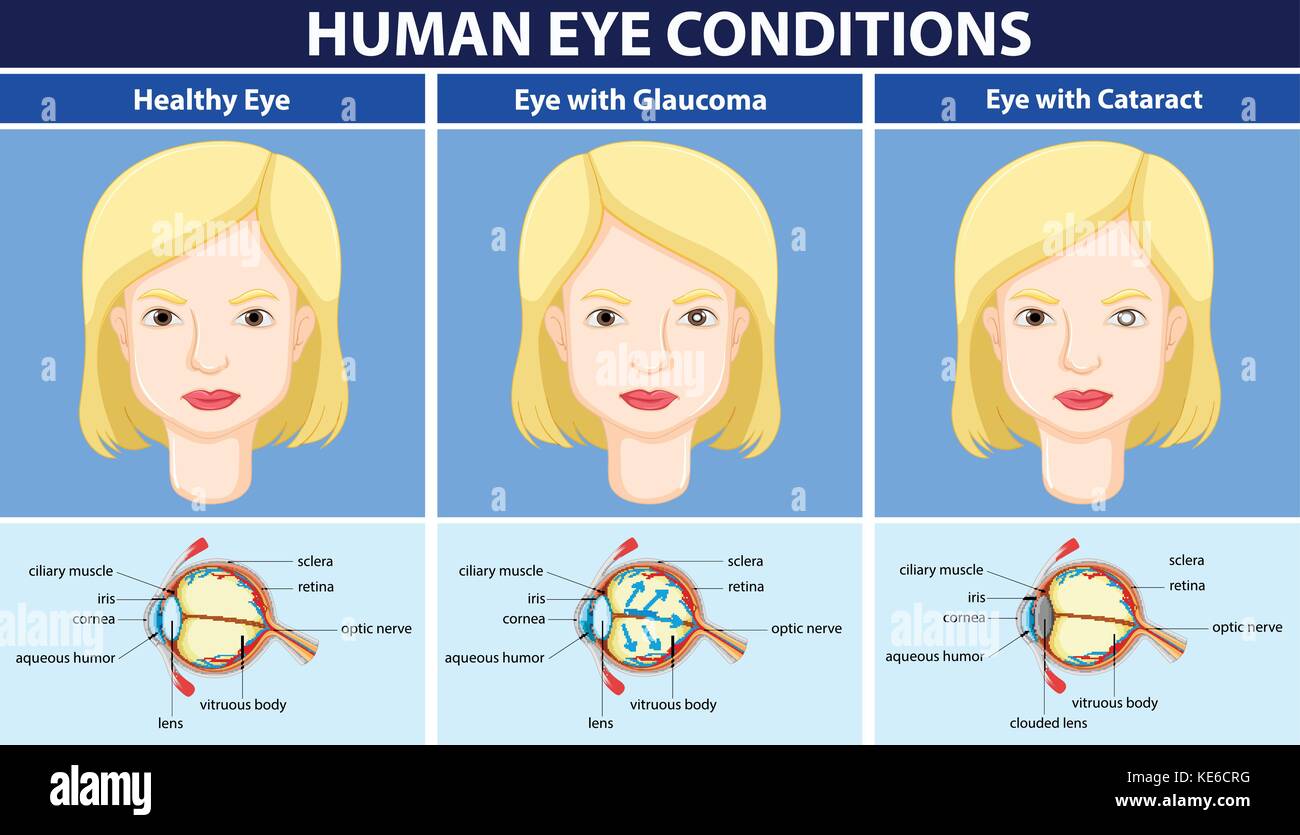 Diagram showing human eye conditions illustration Stock Vector Image ...