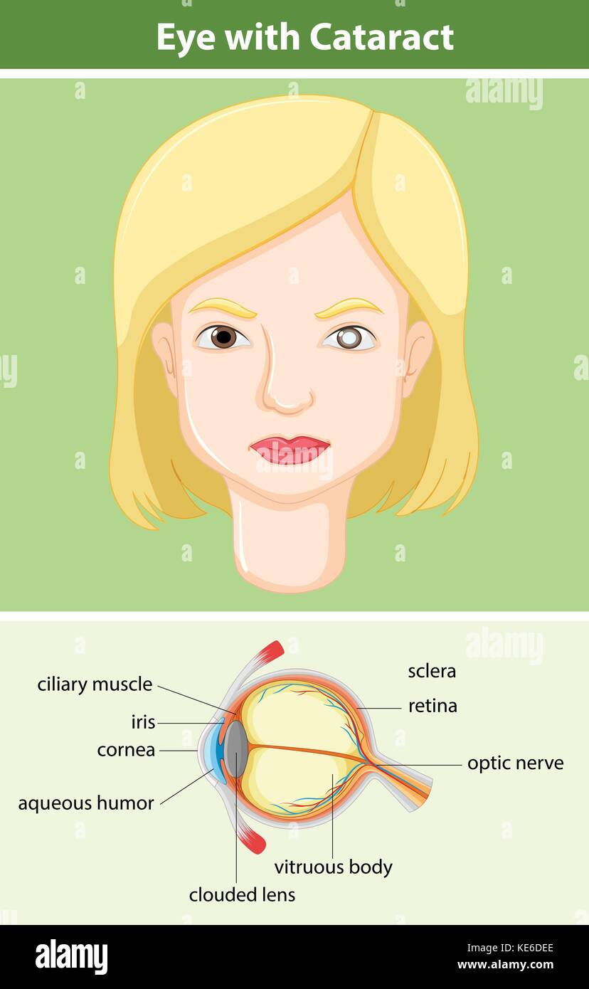 Diagram showing eye with cataract illustration Stock Vector Image & Art ...