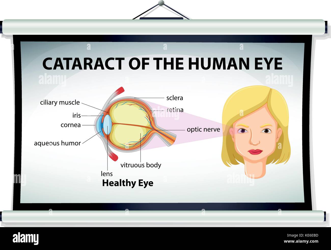 Diagram of cataract in human eye illustration Stock Vector Image & Art ...