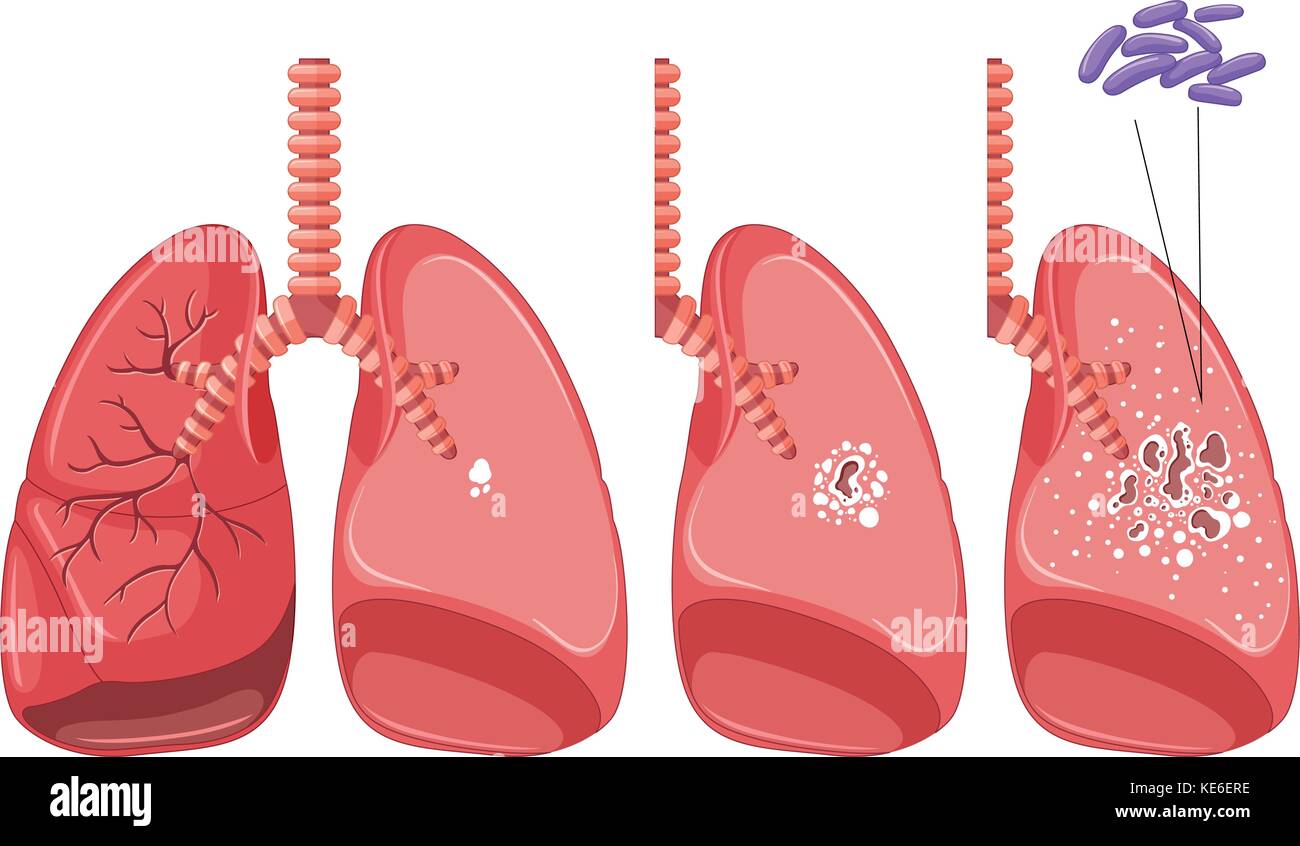 Tuberculosis In Human Lungs Illustration Stock Vector Image And Art Alamy