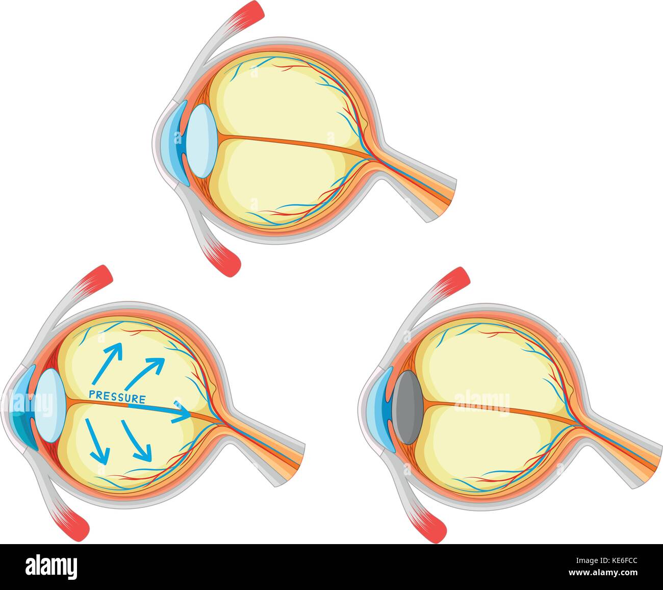 Diagram showing eyes disease illustration Stock Vector Image & Art - Alamy