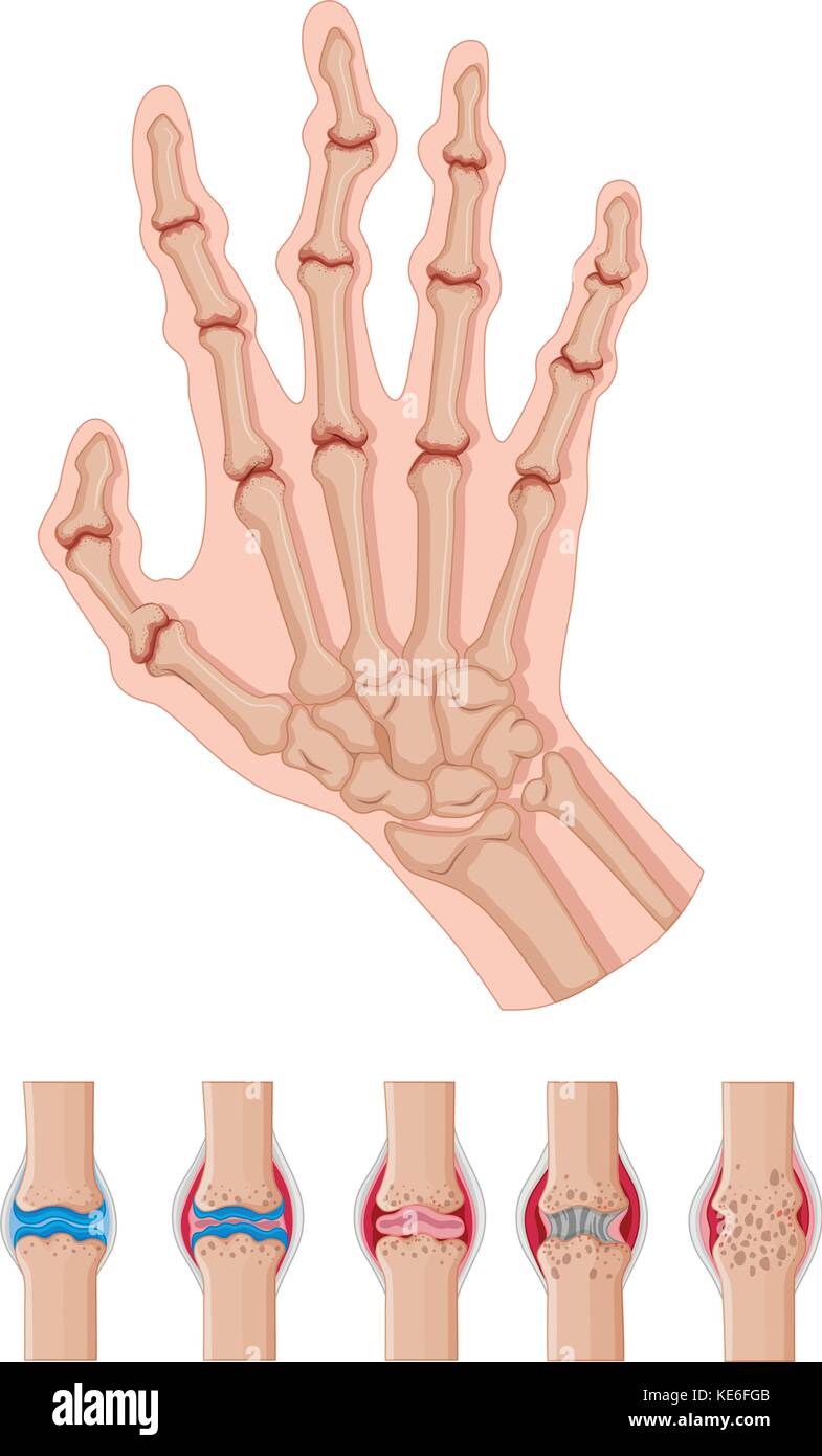 Rheumatoid arthritis drawing Stock Vector Images - Alamy