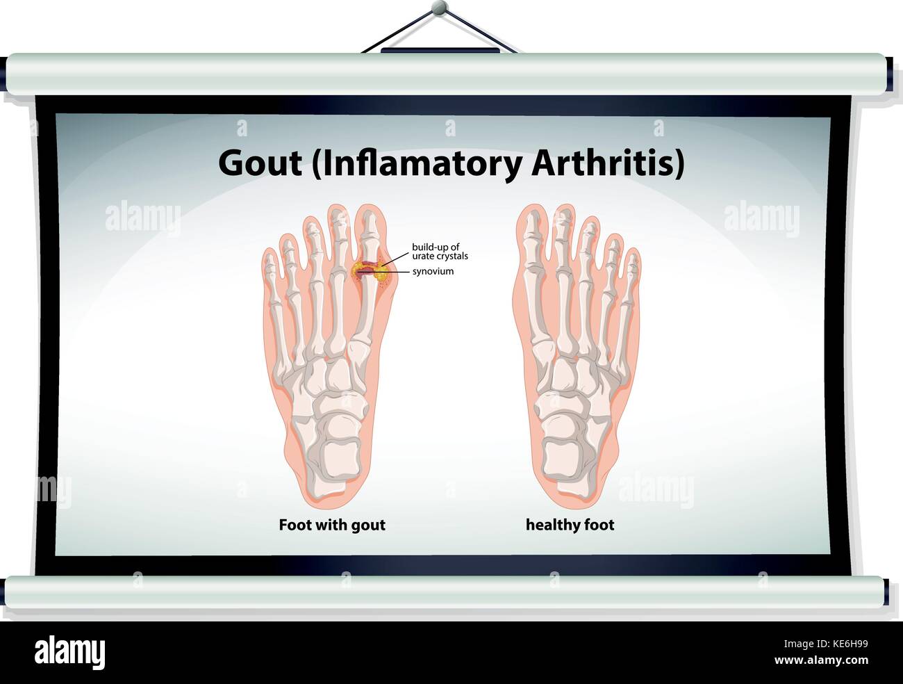 Gout Illustration Stock Photos & Gout Illustration Stock Images - Alamy