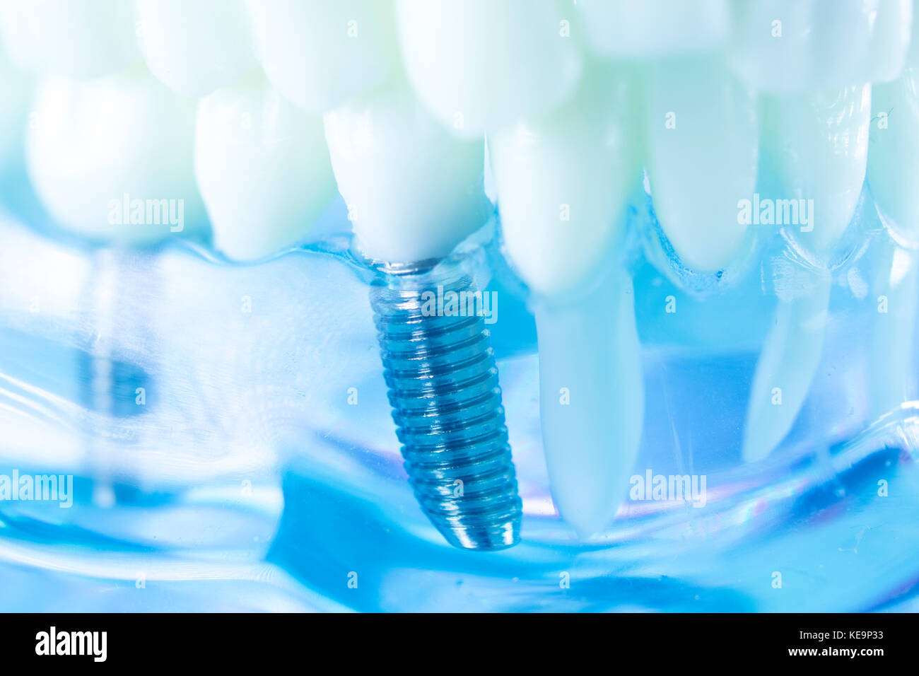 Dental titanium aesthetic orthodontic tooth implant in dentists mouth ...