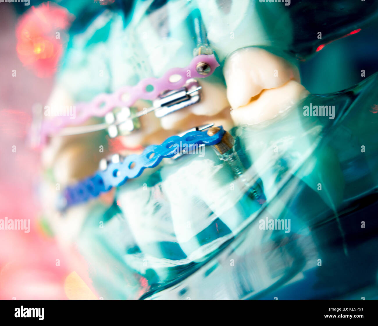 Dental teeth retainers metal aligners brackets to straighten teeth in ...