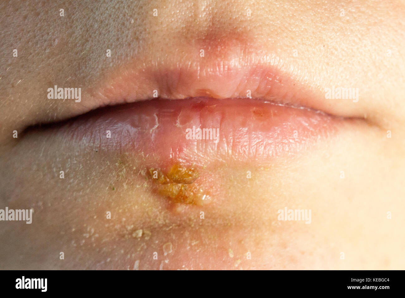 Face Scabs Stock Photos & Face Scabs Stock Images - Alamy