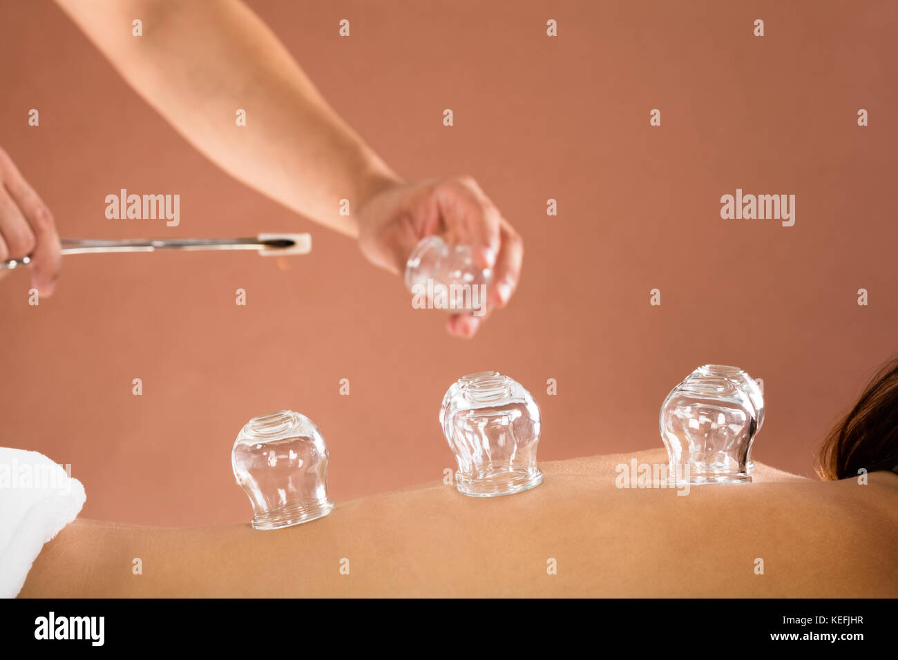 Therapist giving fire cupping hi-res stock photography and images - Alamy