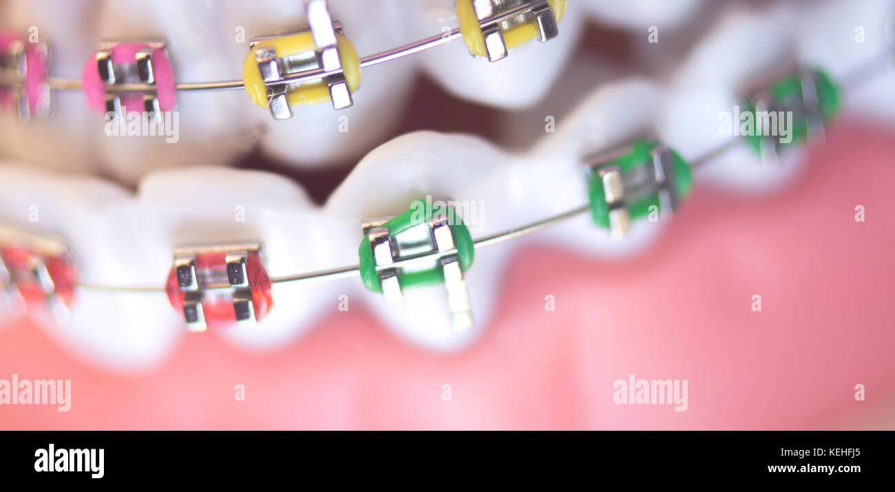 Cosmetic dentistry orthodontics dental metal wire teeth brackets ...