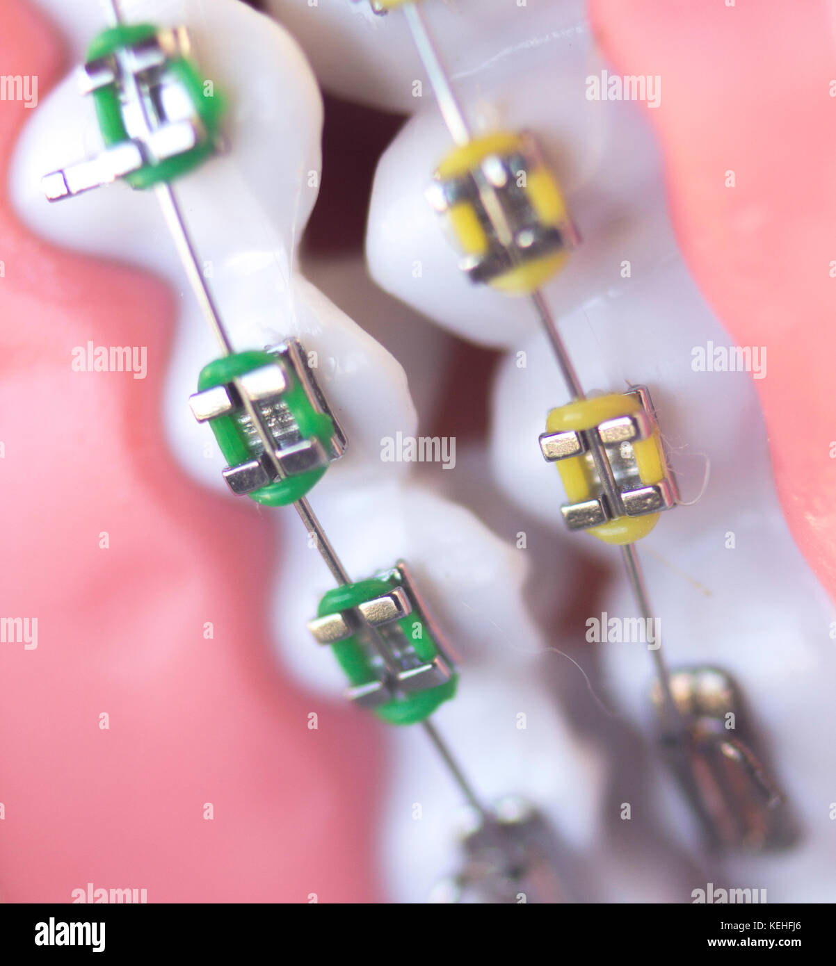 Cosmetic dentistry orthodontics dental metal wire teeth brackets ...