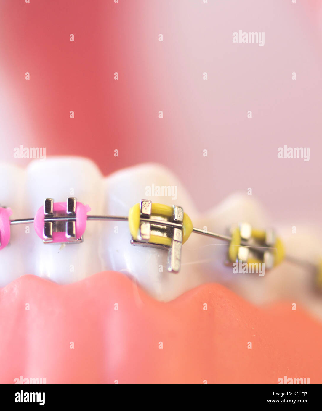 Cosmetic dentistry orthodontics dental metal wire teeth brackets ...