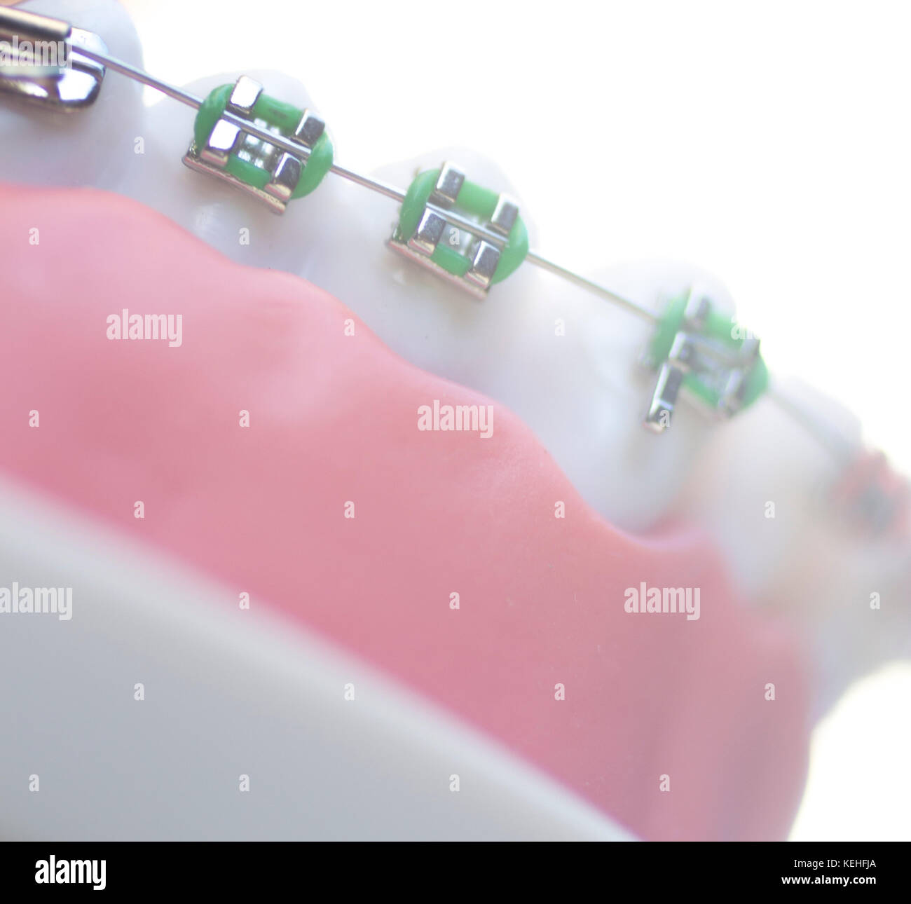 Cosmetic dentistry orthodontics dental metal wire teeth brackets ...