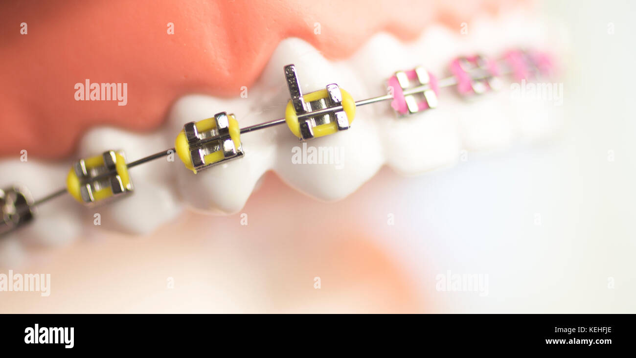 Cosmetic dentistry orthodontics dental metal wire teeth brackets ...