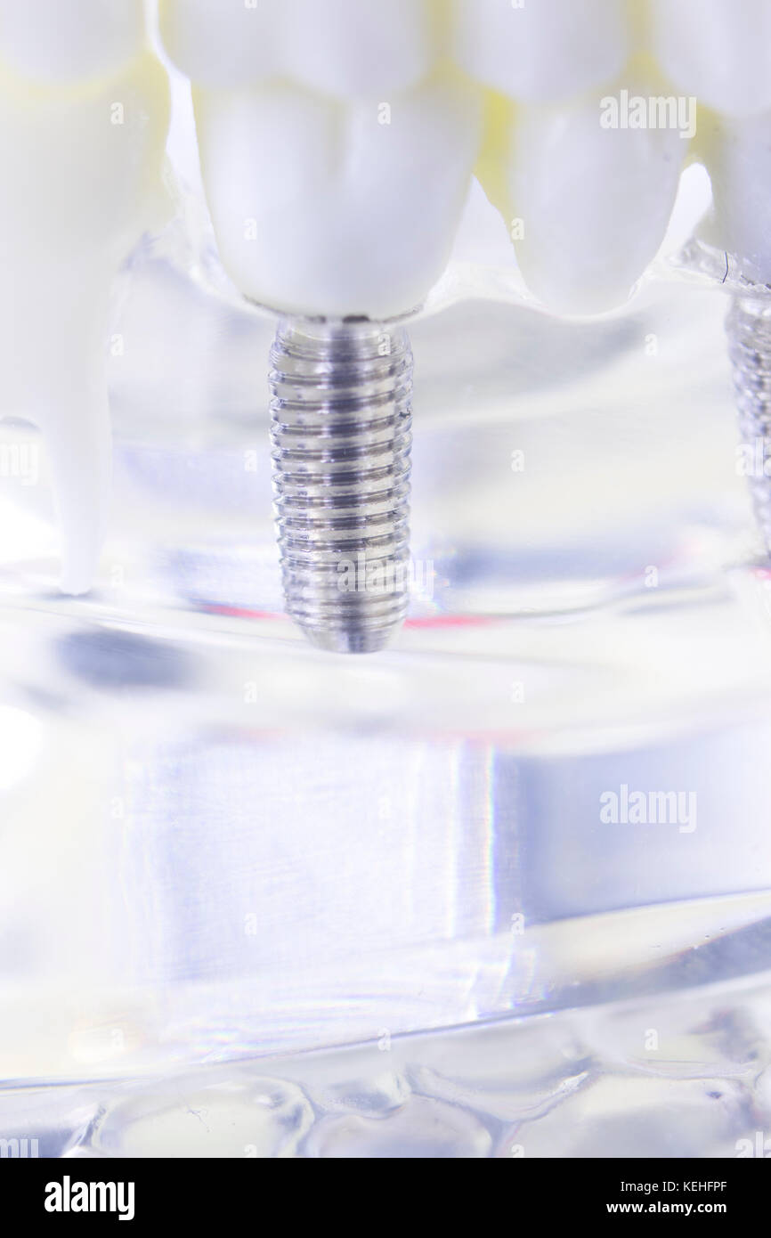 Dental titanium aesthetic orthodontic tooth implant in dentists mouth ...