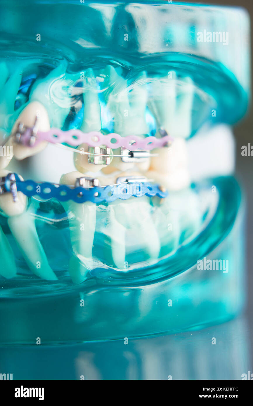 Dental teeth retainers metal aligners brackets to straighten teeth in ...