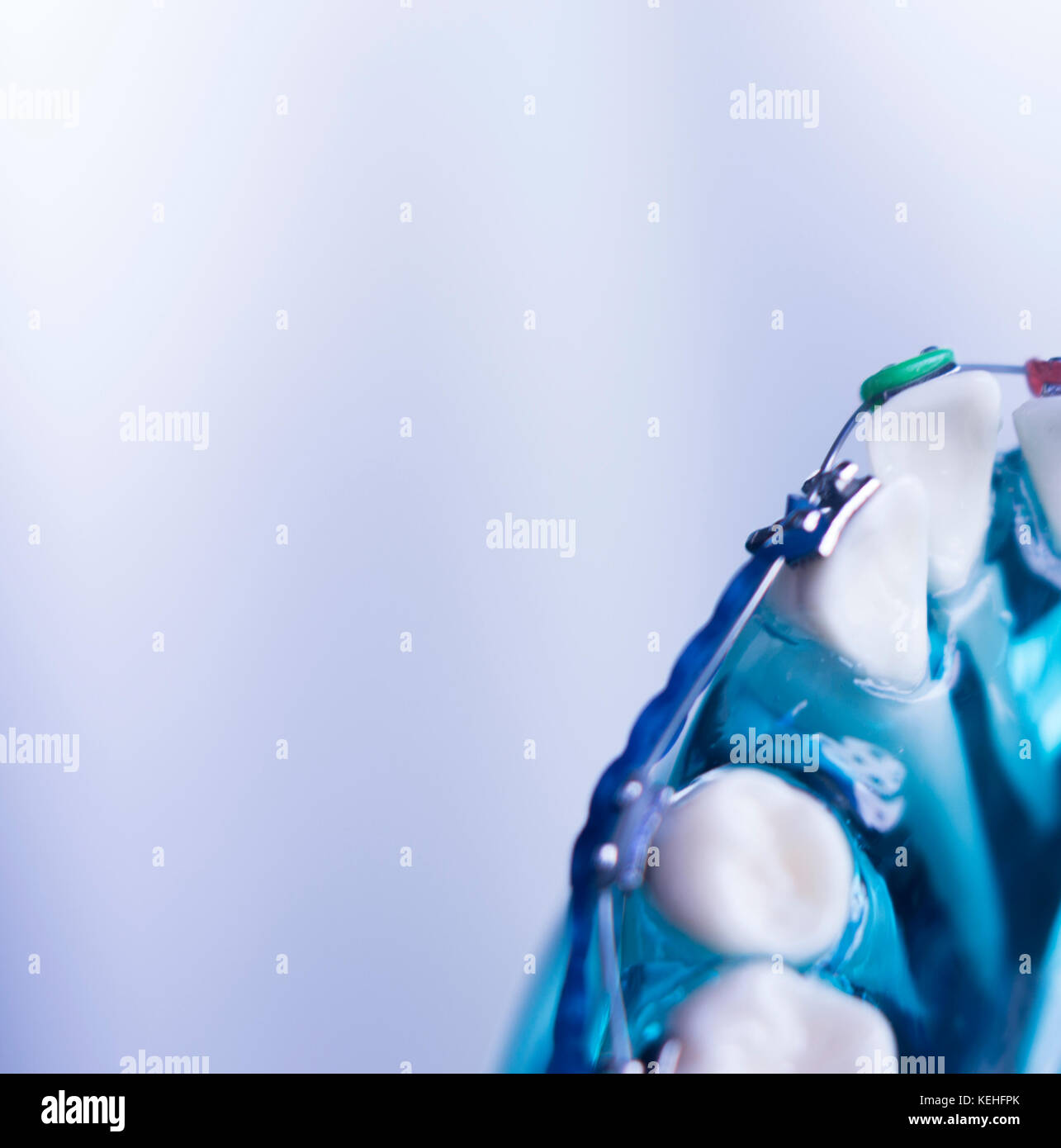 Dental teeth retainers metal aligners brackets to straighten teeth in ...