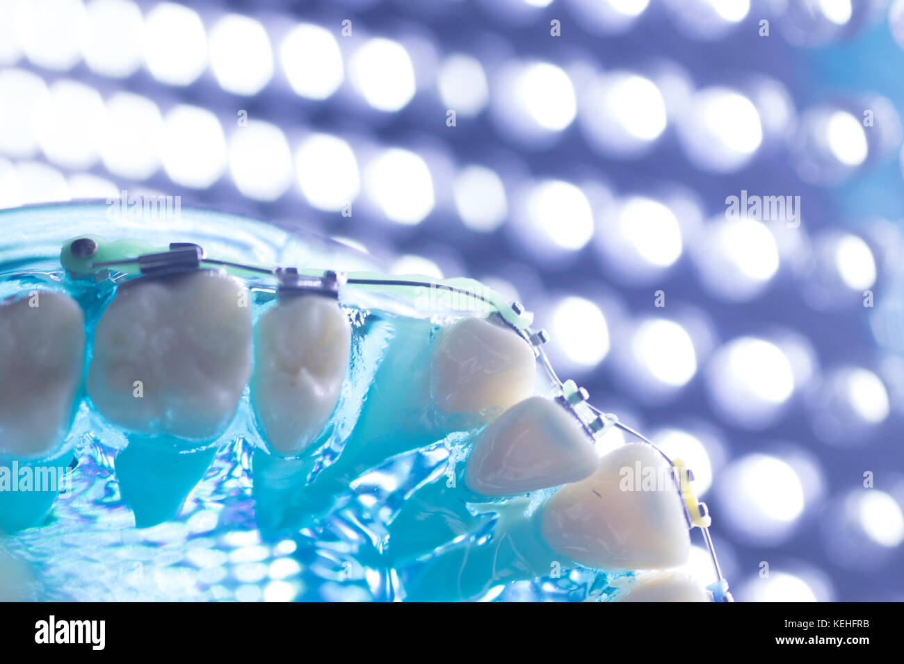 Dental teeth retainers metal aligners brackets to straighten teeth in ...