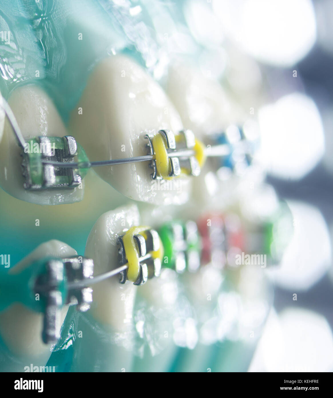 Dental teeth retainers metal aligners brackets to straighten teeth in ...