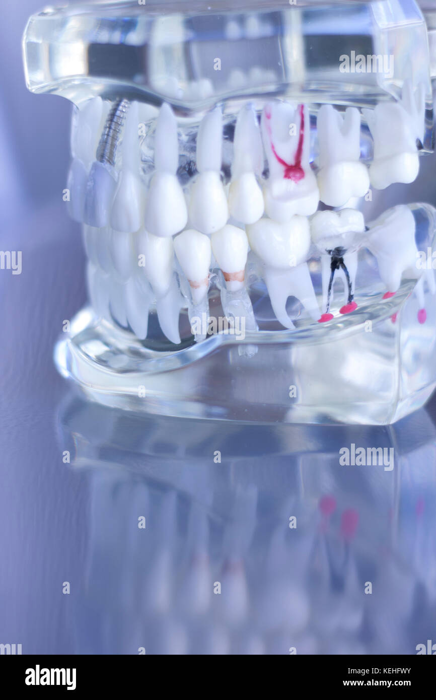 Dentsts dental prosthetic teeth, gums, jaw teaching student model Stock ...