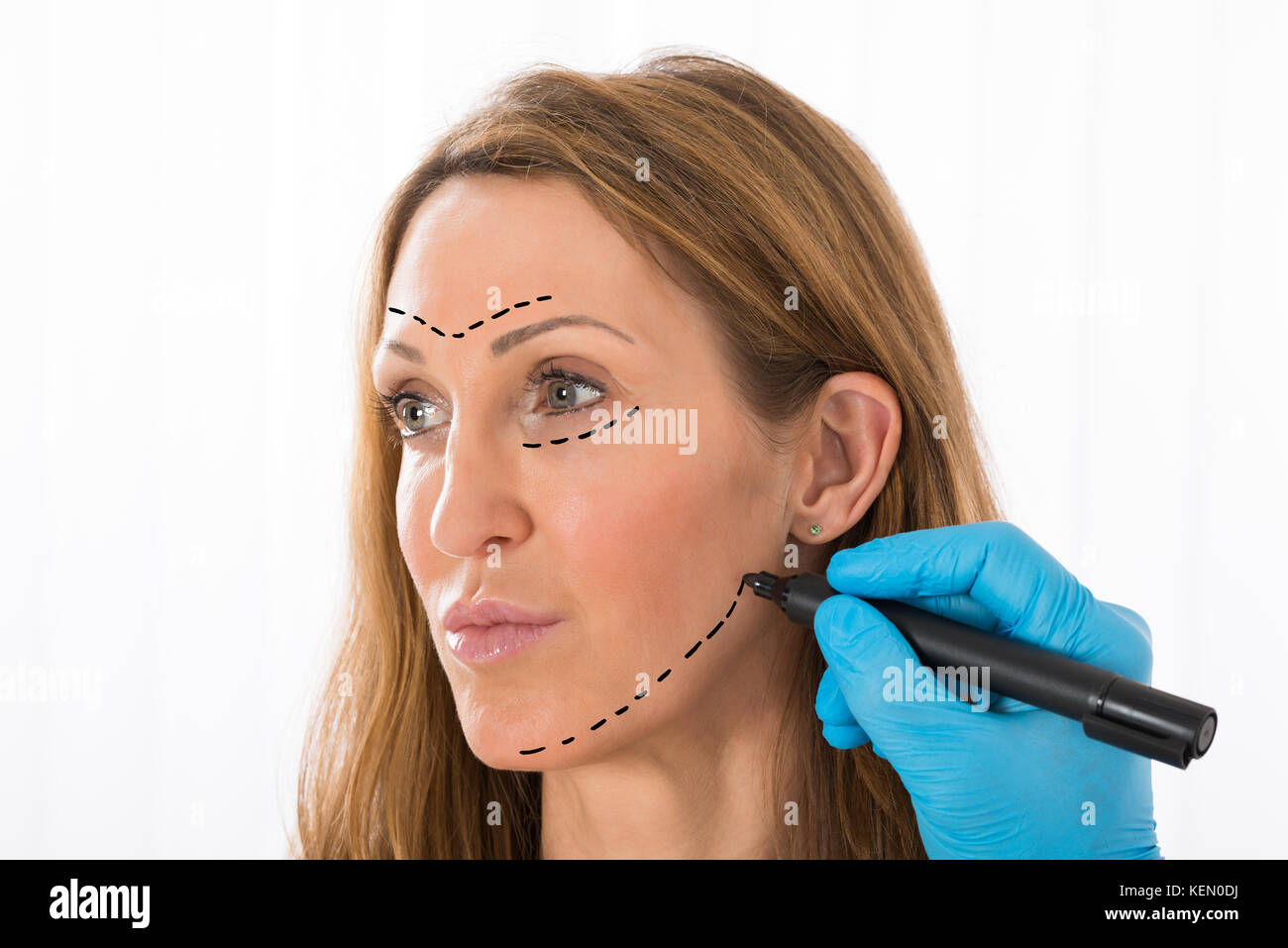 Close-up Of Surgeon Hands Drawing Correction Lines On Woman Face With ...