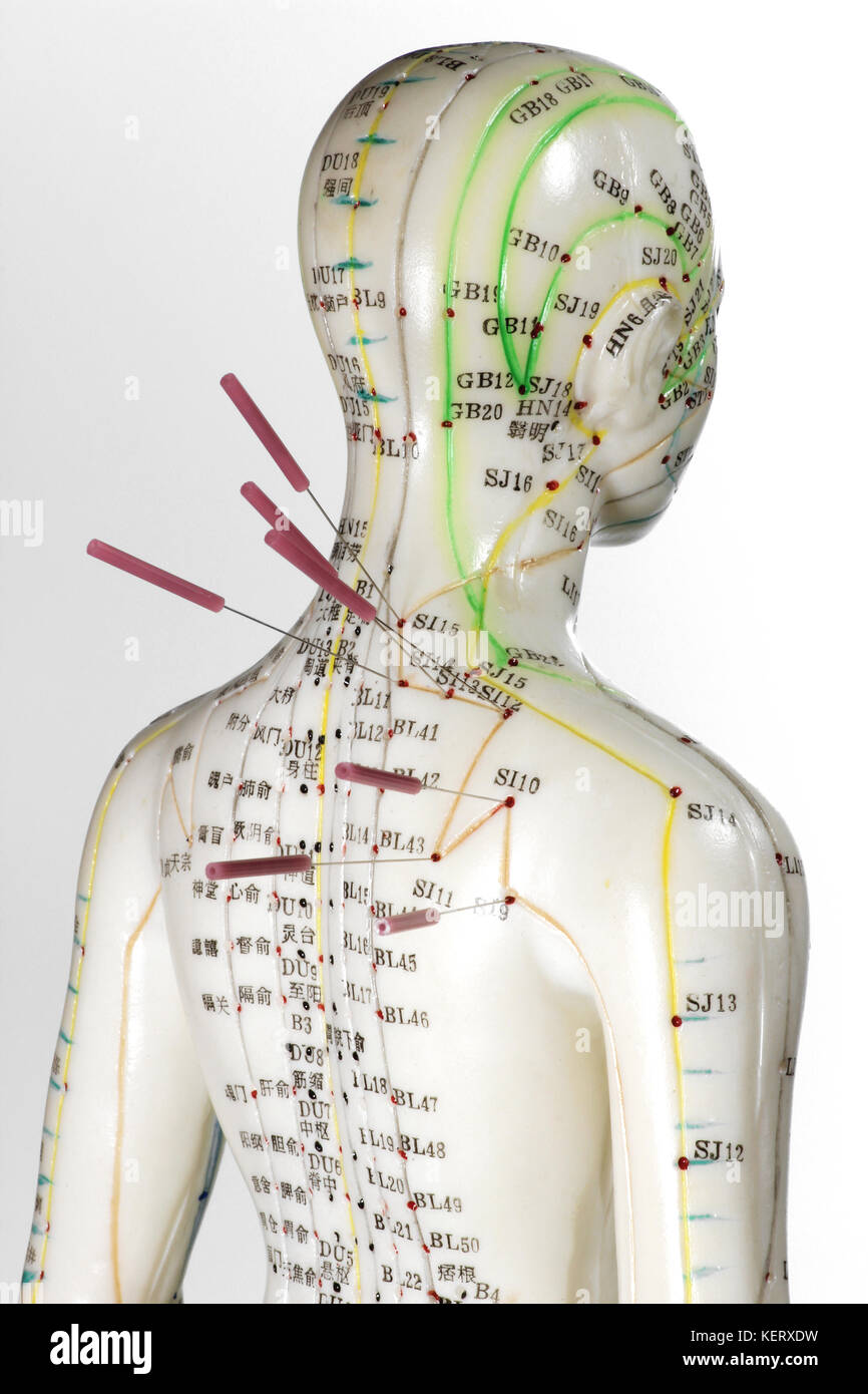female acupuncture model with needles in the shoulder Stock Photo - Alamy