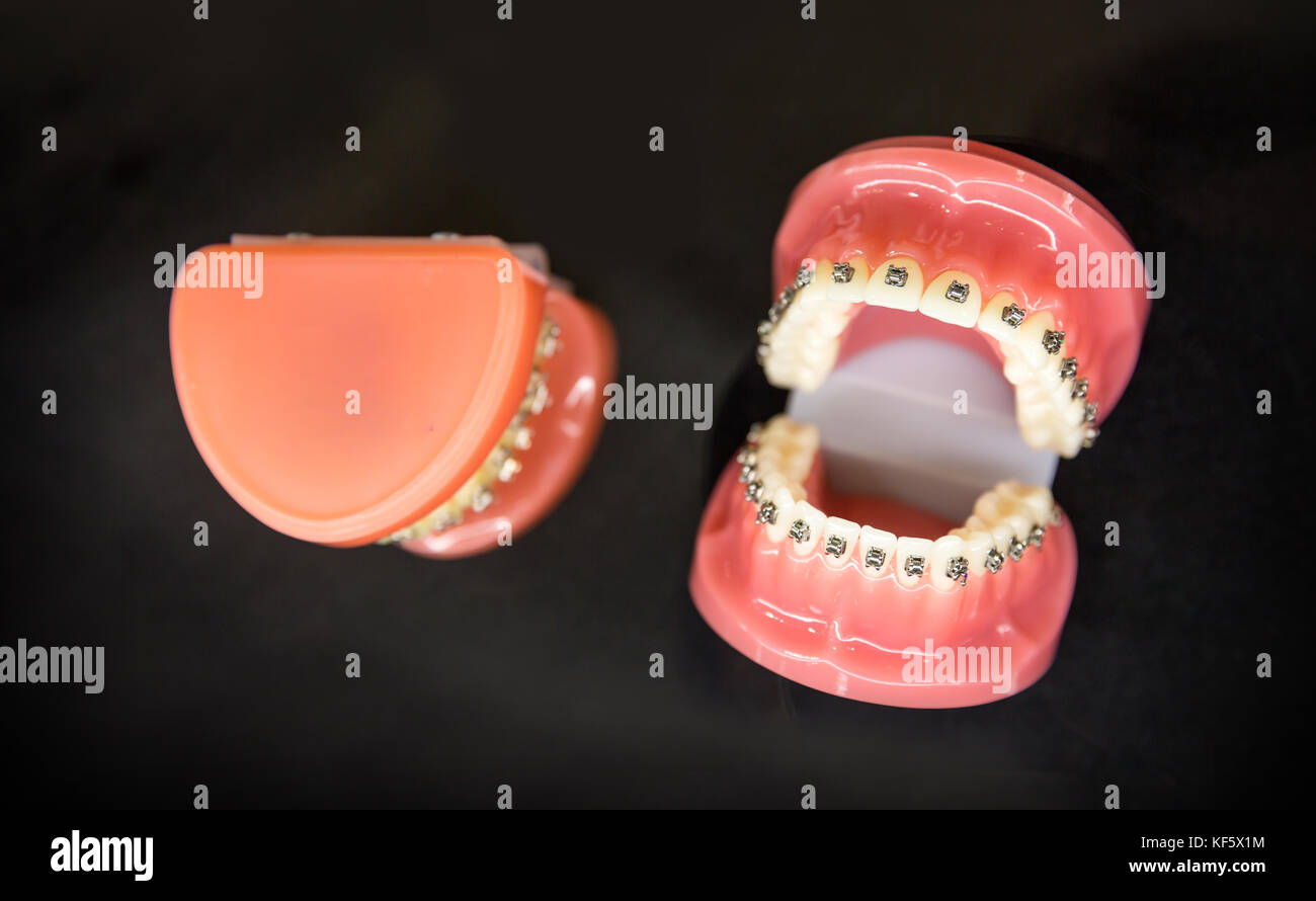 Orthodontic, denture closeup, black background Stock Photo - Alamy