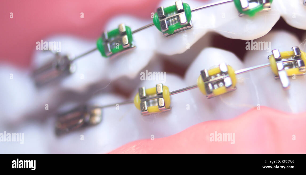 Cosmetic dentistry orthodontics dental metal wire teeth brackets ...