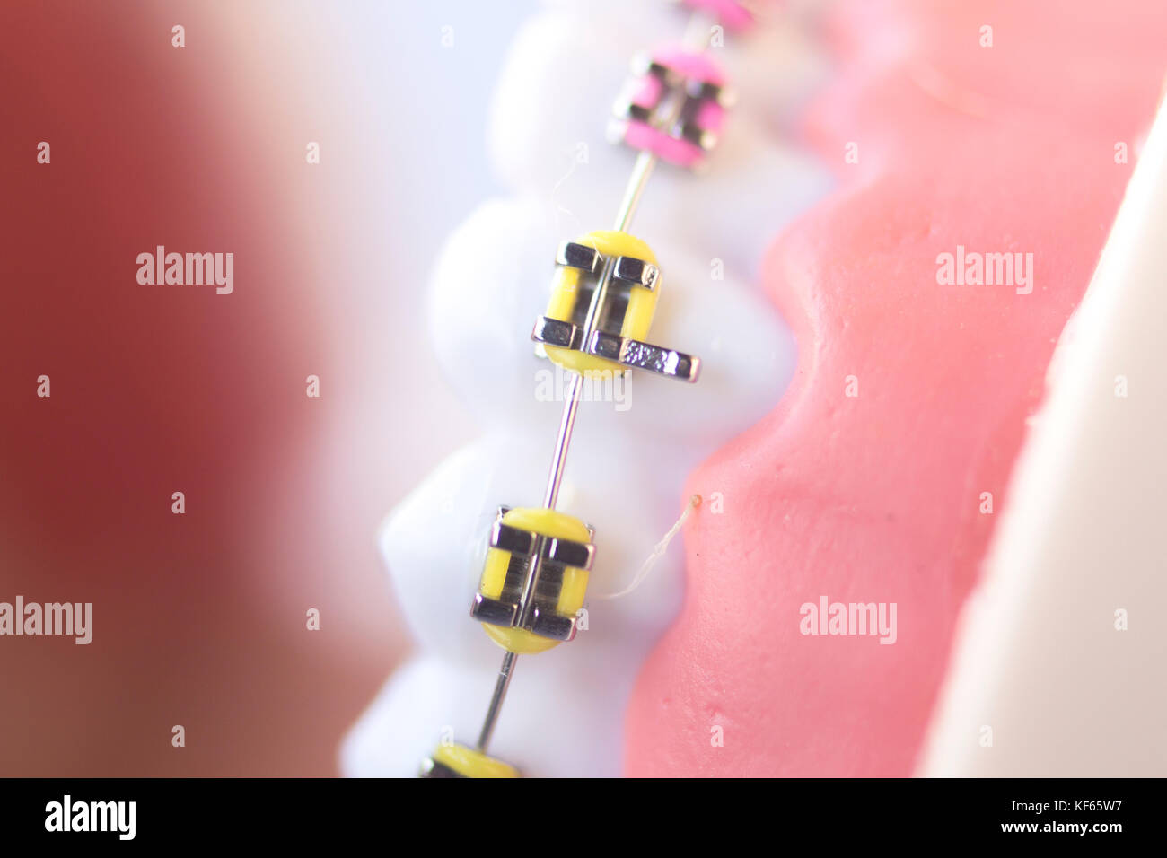 Cosmetic dentistry orthodontics dental metal wire teeth brackets ...