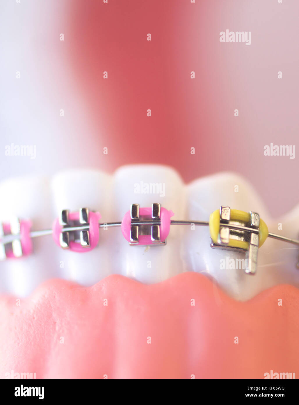 Cosmetic dentistry orthodontics dental metal wire teeth brackets ...