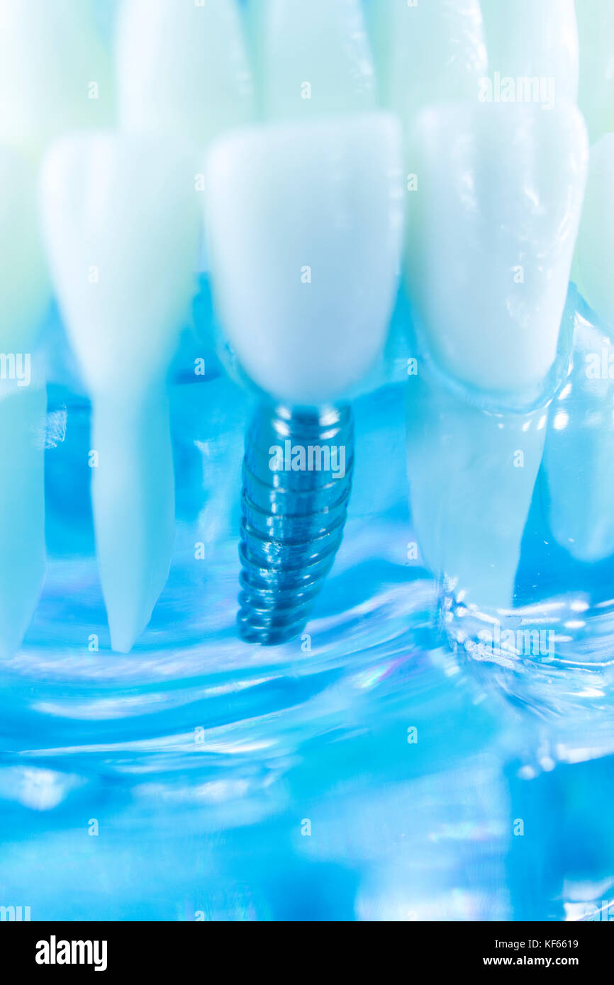 Dental titanium aesthetic orthodontic tooth implant in dentists mouth ...