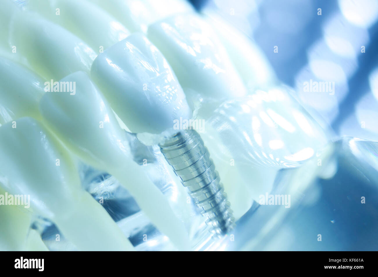 Dental titanium aesthetic orthodontic tooth implant in dentists mouth ...