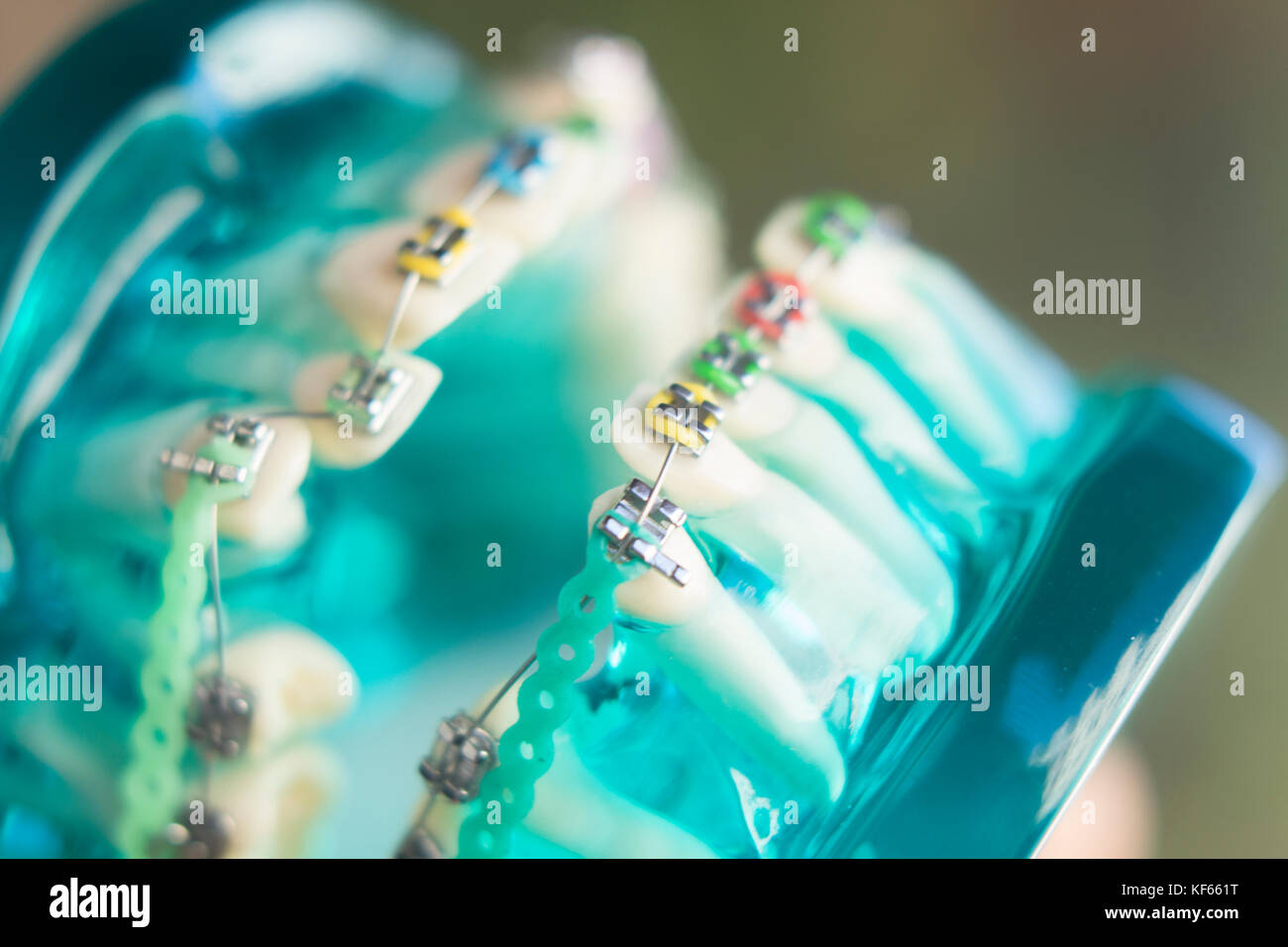 Dental teeth retainers metal aligners brackets to straighten teeth in ...