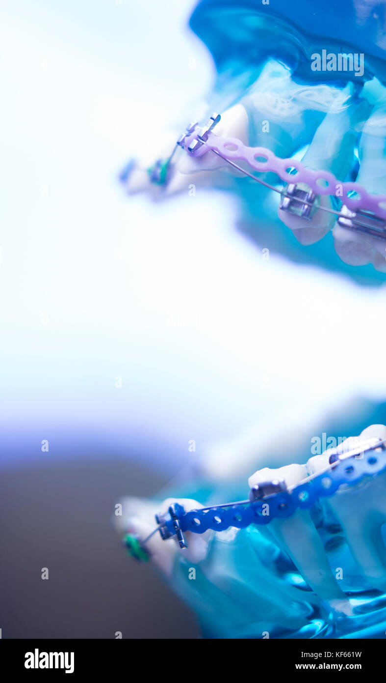 Dental teeth retainers metal aligners brackets to straighten teeth in ...