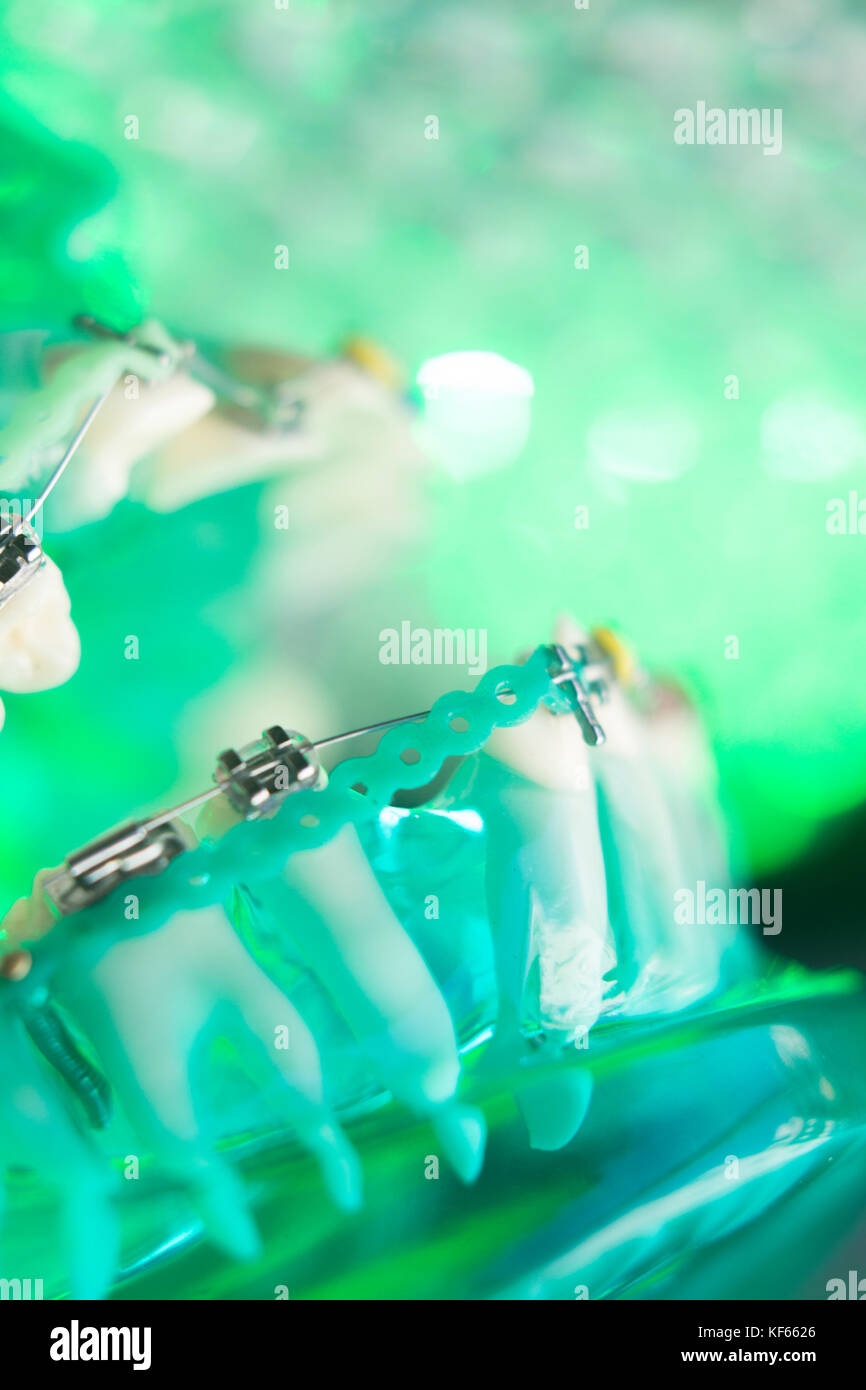 Dental teeth retainers metal aligners brackets to straighten teeth in ...