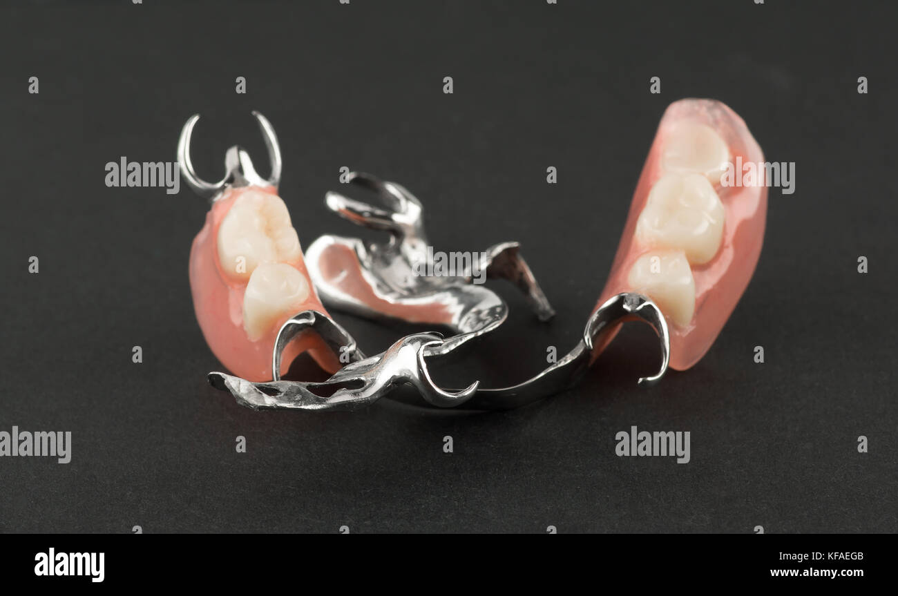 Elements of a clasp prosthesis close-up isolated on a black background ...