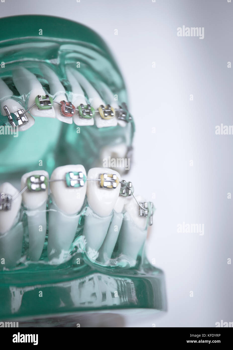 Denture for students with classic dental metal orthodontics. Color ...