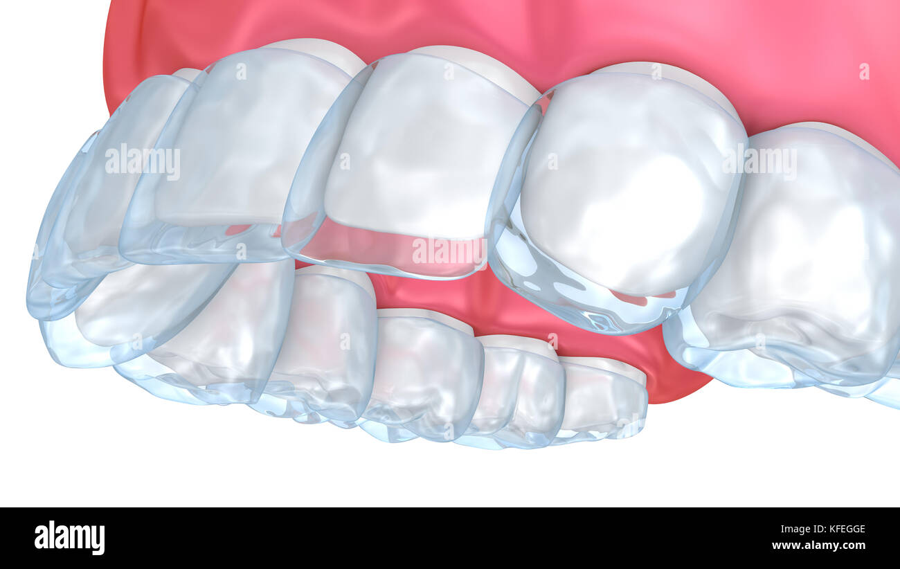 Teeth whitening process. Medically accurate tooth 3D illustration Stock ...