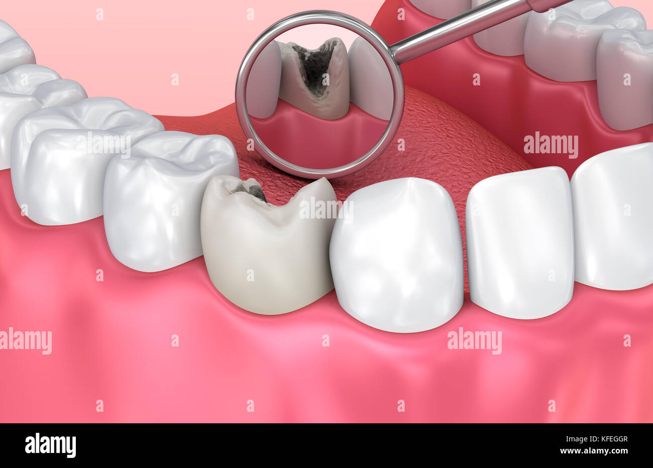Teeth inspection with mirror. Medically accurate tooth 3D illustration ...