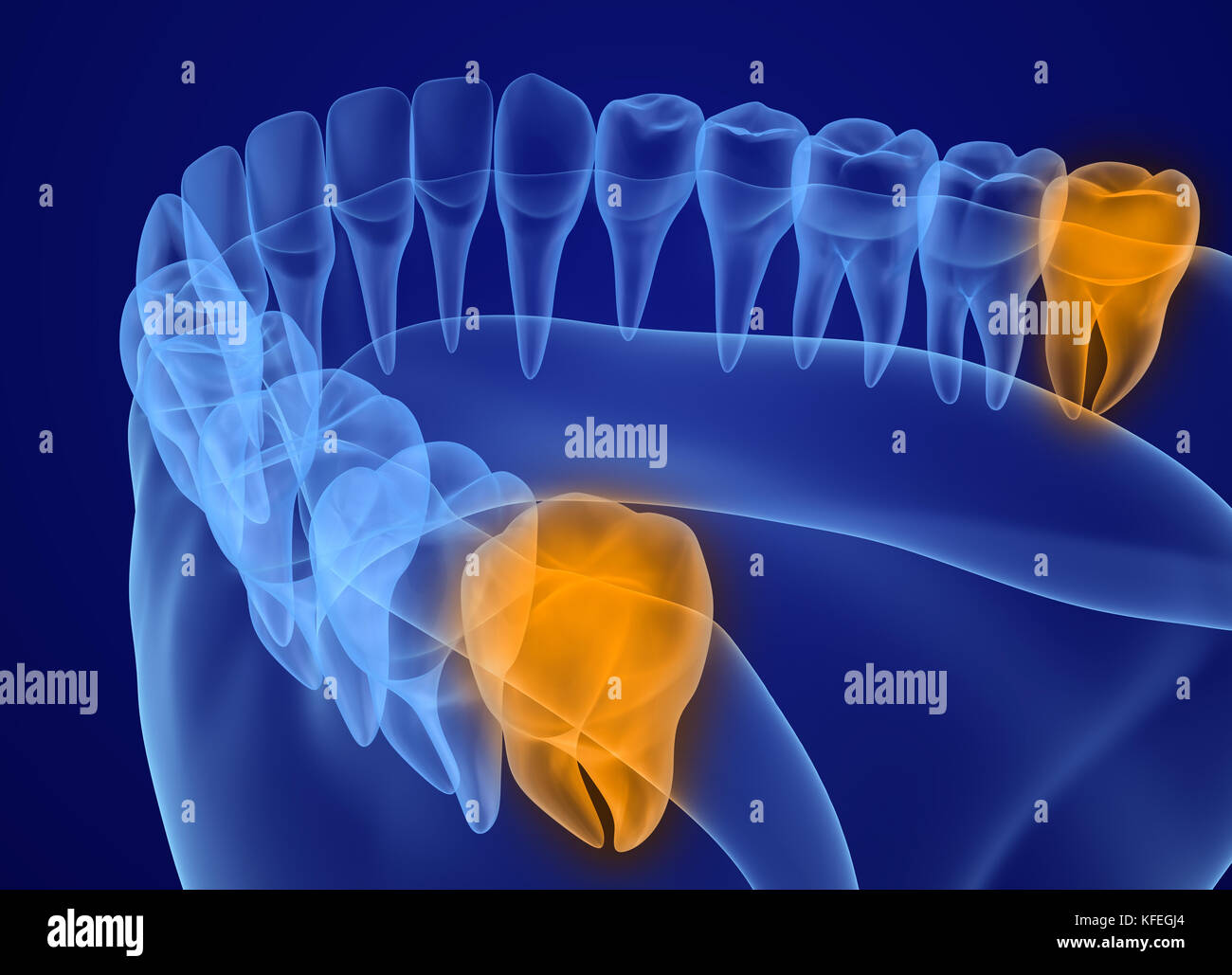 Wisdom tooth hi-res stock photography and images - Alamy
