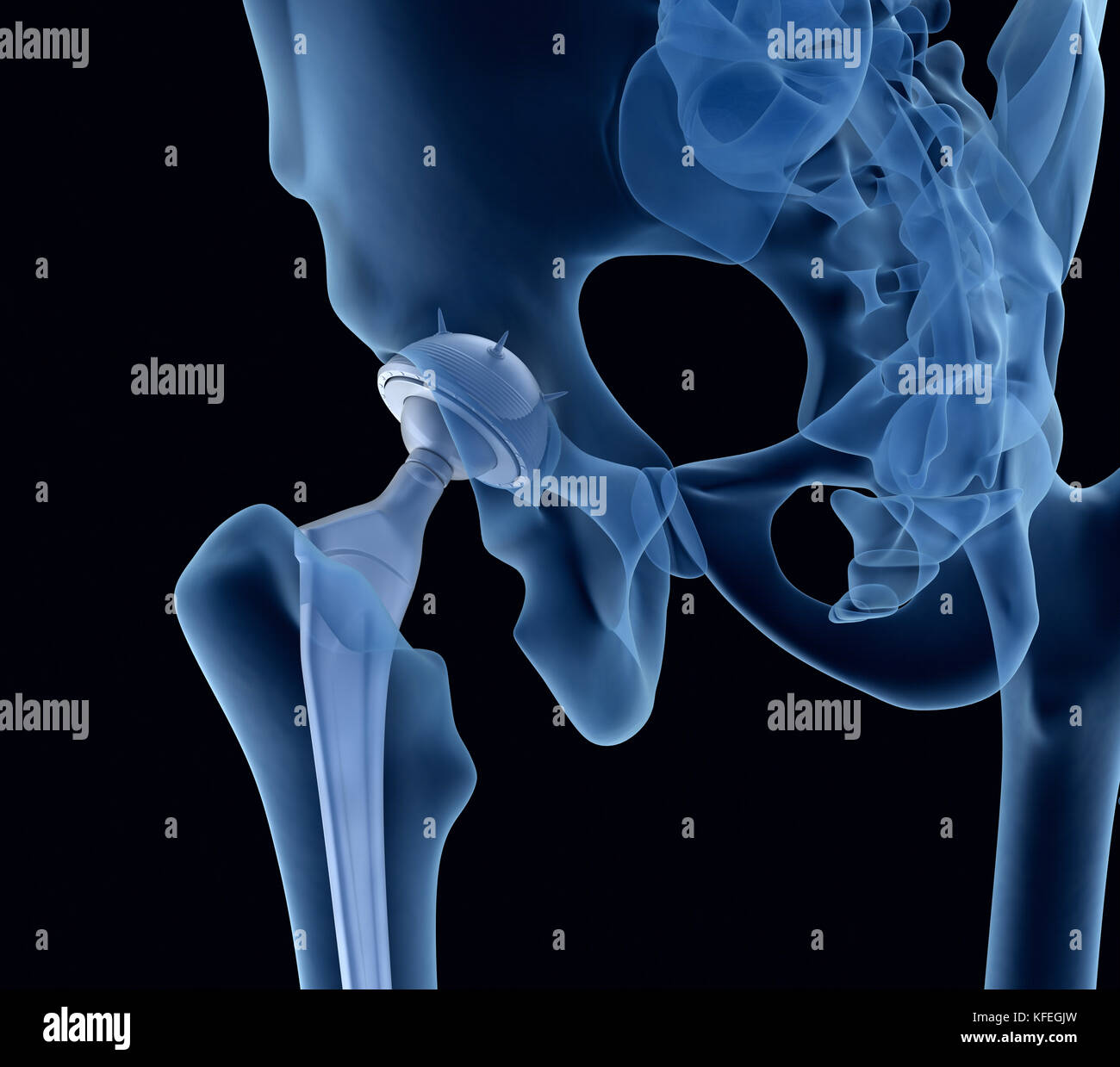 Hip prosthesis hi-res stock photography and images - Alamy