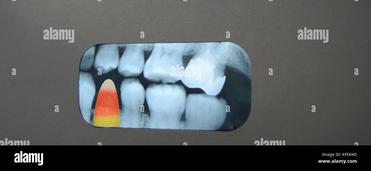 candy corn in dental x-ray of teeth Stock Photo - Alamy