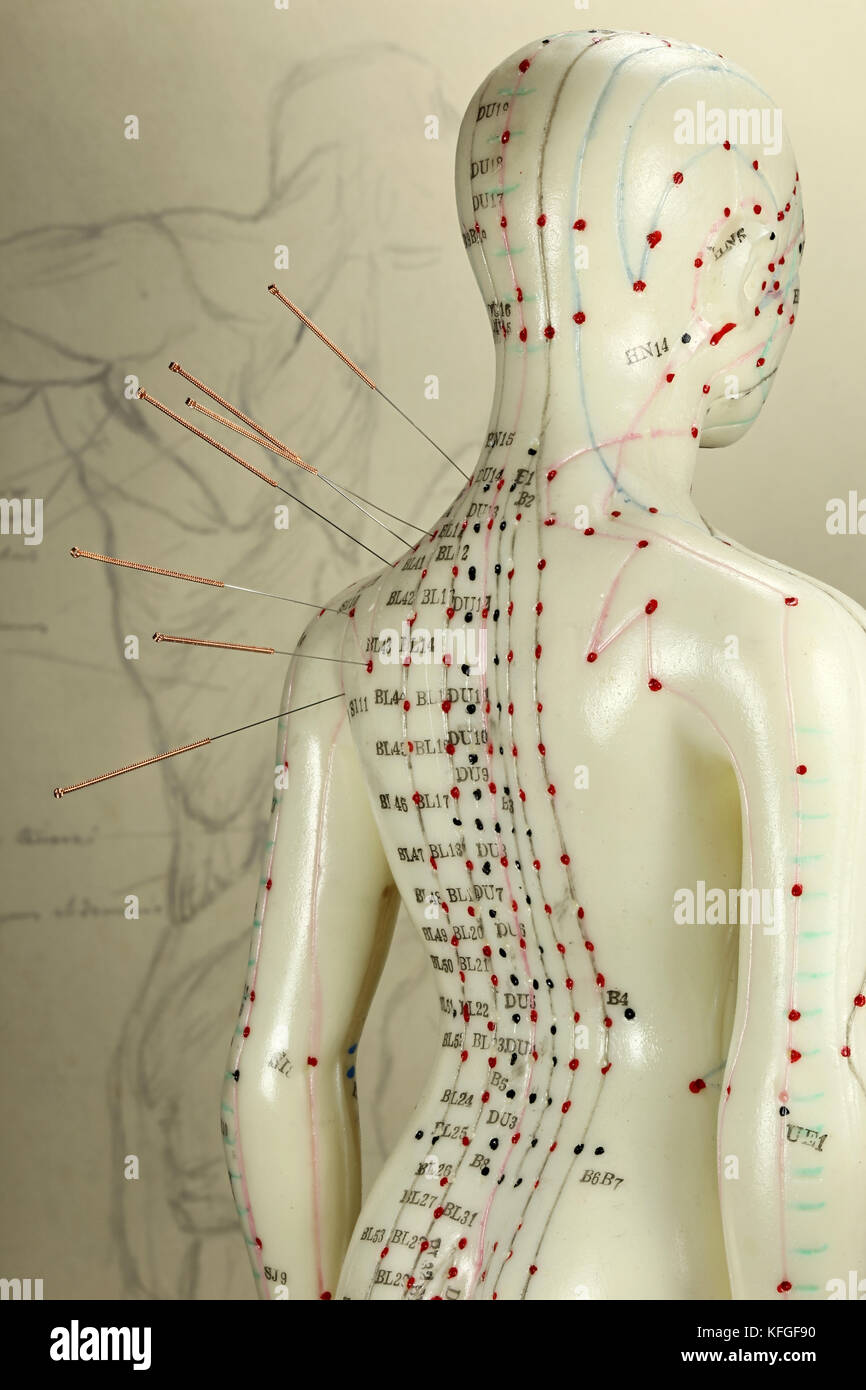 female acupuncture model with needles in the shoulder Stock Photo - Alamy